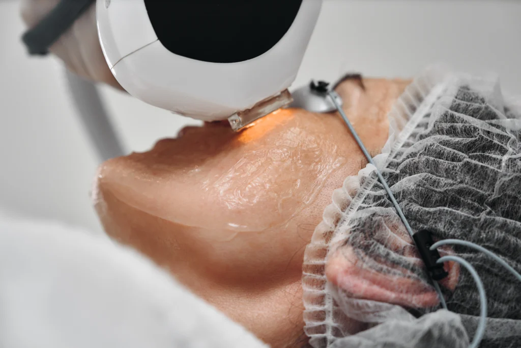 Sciton Laser Hair Removal: How Effective Is It?